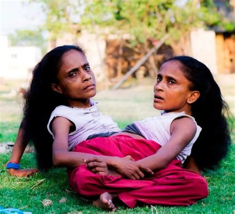 Image result for Java Island Siamese Twins