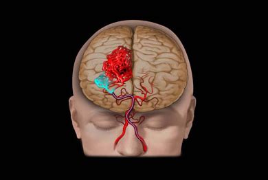 Image result for Embolization Procedure AVM