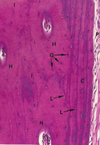 Image result for Types of Abnormal Bone Formation