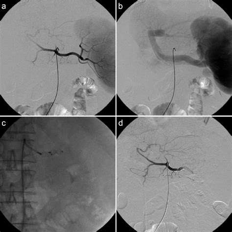 Image result for Angiogram with Embolization