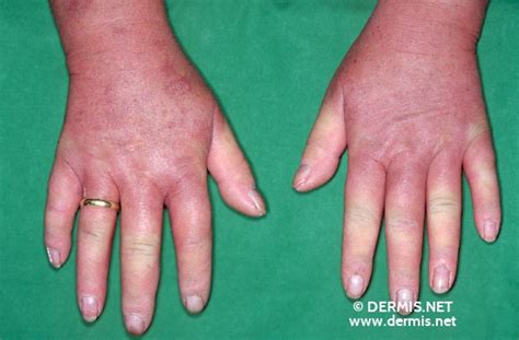 Image result for Scleroderma Skin