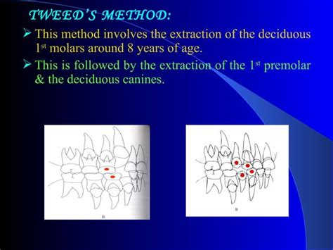 Image result for Serial Extraction Case Report