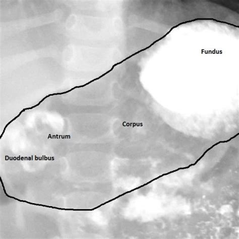 Image result for Invagination