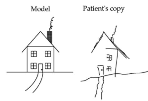 Image result for Contralateral Neglect
