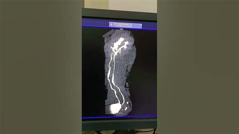 Image result for Urogram CT Scan with Contrast Normal
