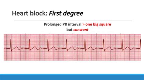 Image result for ECG Step by Step