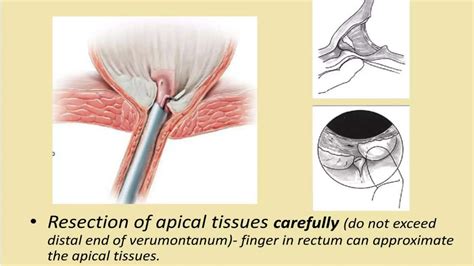 Image result for Transurethral Resection Procedure
