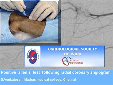 Image result for Angiogram Radial