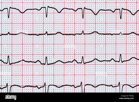 Image result for Normal EcG