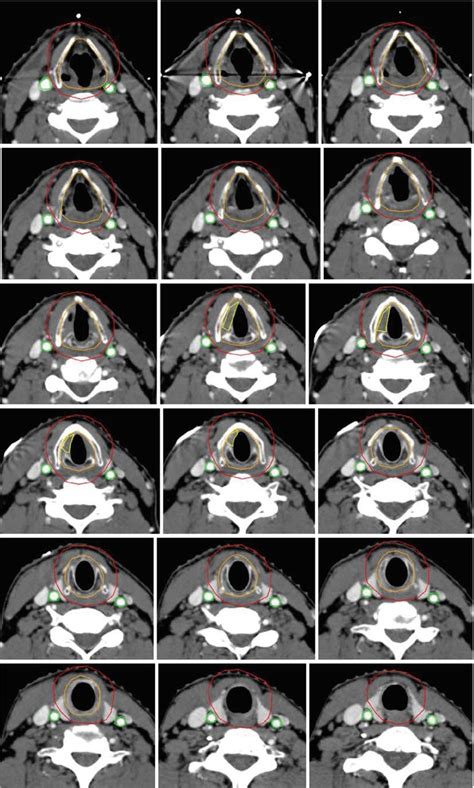 Stage Larynx Cancer | Radiology Key