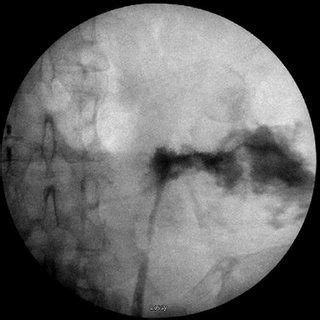 Image result for Urogram Triphasic