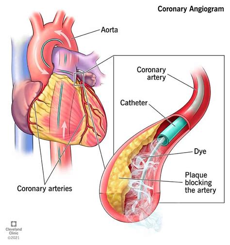 Image result for Different Types of Angiogram