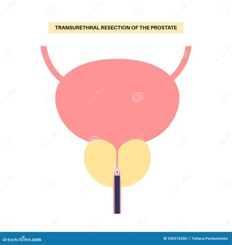 Image result for Transurethral Procedure