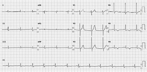 Image result for Types of ST Depression