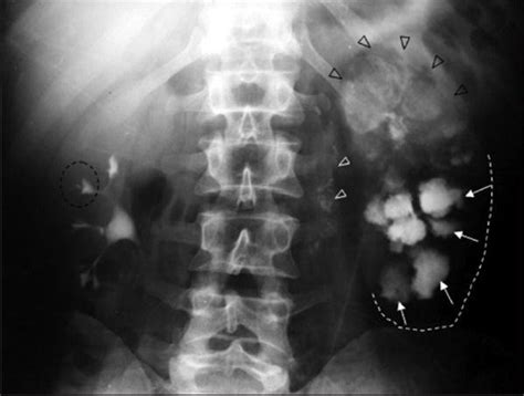 Image result for Delayed Phase CT Urogram