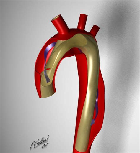 Image result for Type 2 Aortic Dissection