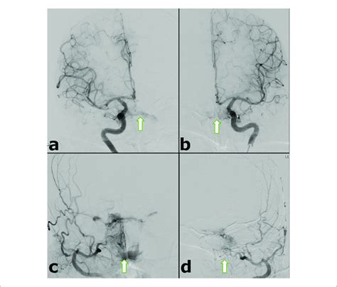 Image result for Angiogram with Embolization