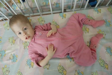 Image result for Birth Defects From Chernobyl Disaster