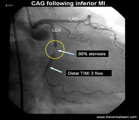Image result for Heart Block Angiogram