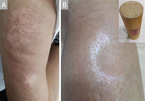 Image result for Scleroderma Skin