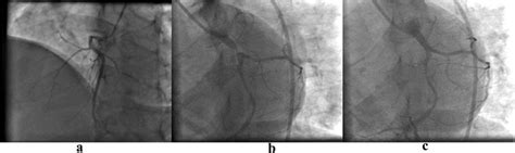 Image result for Angiogram Radial