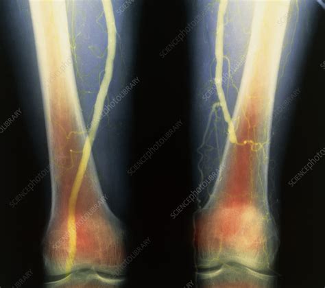 Image result for Heart Block Angiogram