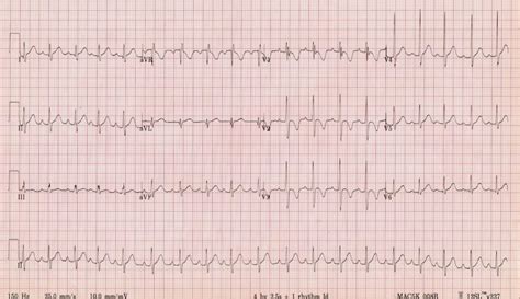 Normal paediatric ECG • LITFL • ECG Library Diagnosis