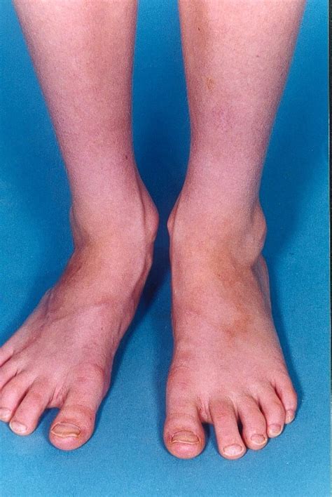 Image result for Scleroderma Skin