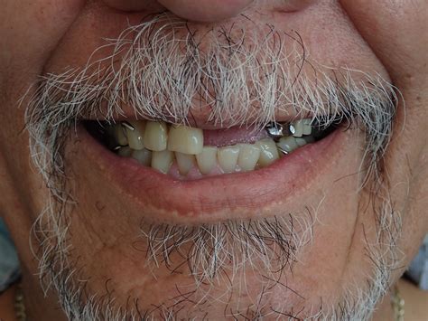 Snap-In Dentures at Advanced Dentistry & Implants – Advanced Dentistry ...