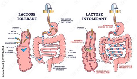 Image result for Lactose Intolerance and Evolution