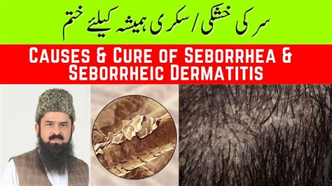 Image result for Treating Seborrhea