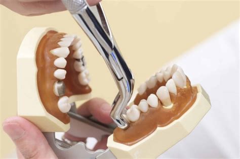 Image result for Surgical Tooth Extraction