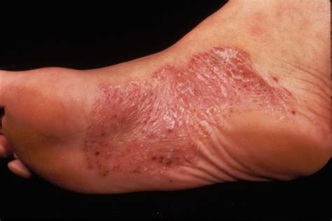 Image result for Types of Pustular Psoriasis