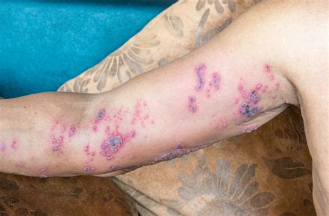 Image result for Shingles On Arm
