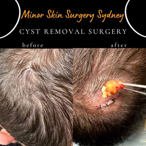 Image result for Upper-Back Cyst Surgery