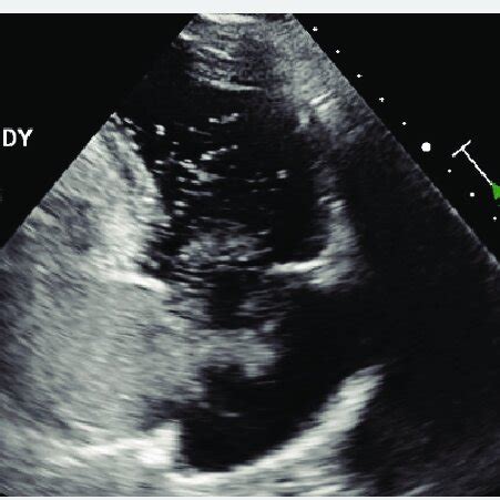 Image result for Intrapulmonary Shunt Bubble Study