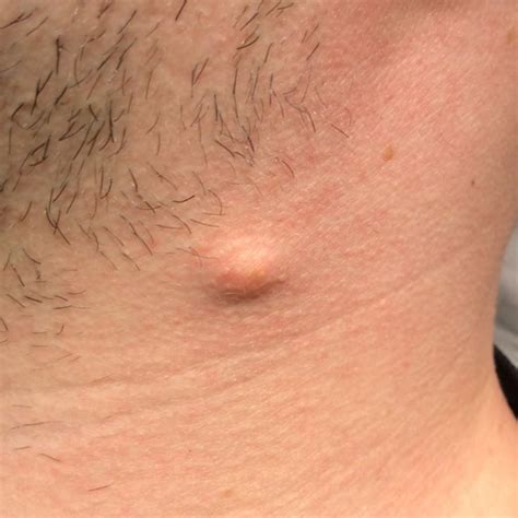 Image result for Big Exploding Cyst Neck