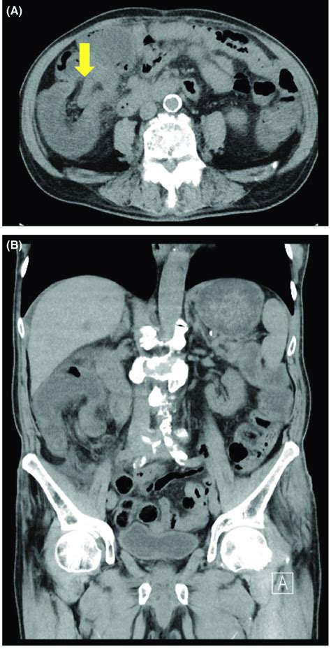 Image result for Intussusception Pseudokidney Sign
