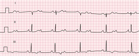 Image result for AV Block PR Interval