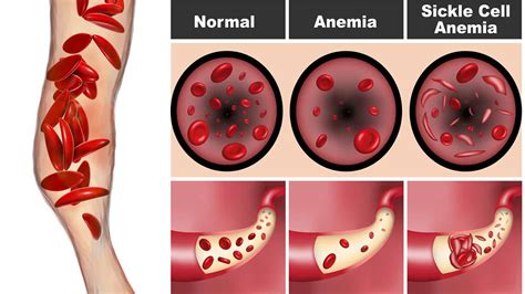 Image result for Sickle Cell Anemia Explained
