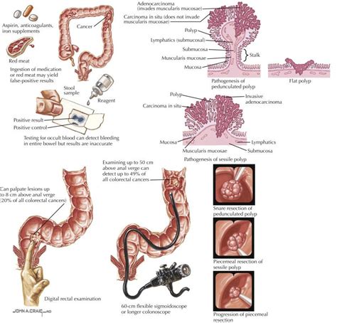 Image result for Colonoscopy Colon Cancer Polyps