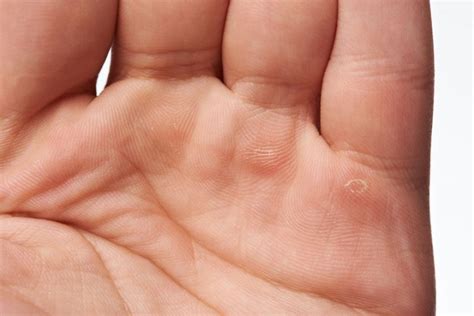 Image result for How to Remove Calluses From Hand