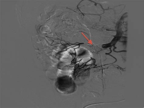 Image result for Angiogram with Embolization