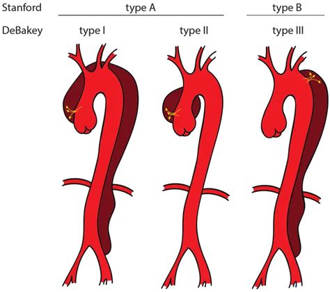 Image result for Type 2 Aortic Dissection