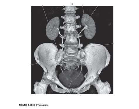 Image result for CT Urogram Topogram Fix