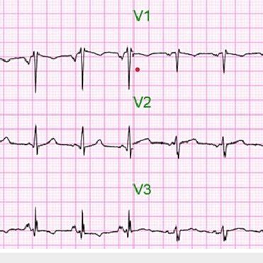 Image result for Normal EcG