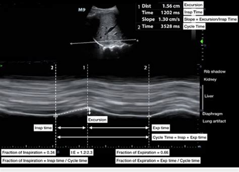 Image result for Respiratory Excursion Assessment