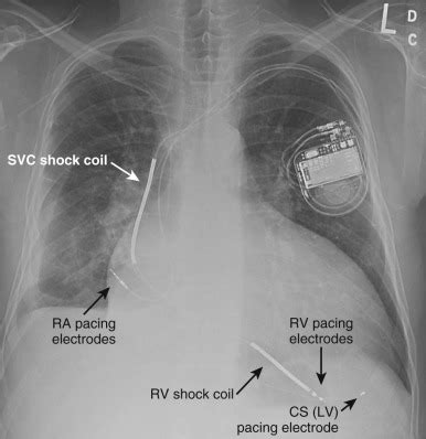 Image result for Remove a Pacemaker and Install Defibrillator