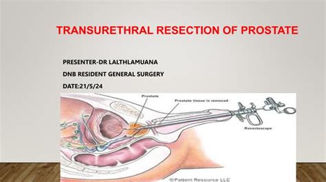 Image result for Transurethral Resection Procedure