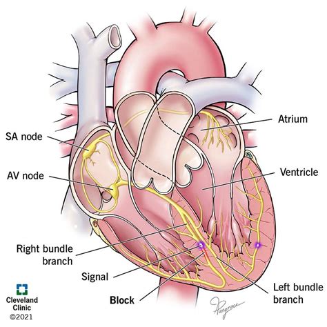 Image result for Incomplete Bundle Branch Block Left Treatment